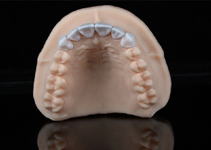 Digital Wax-Up: Anticipating Treatment Outcomes - Golden Smile Dental Lab