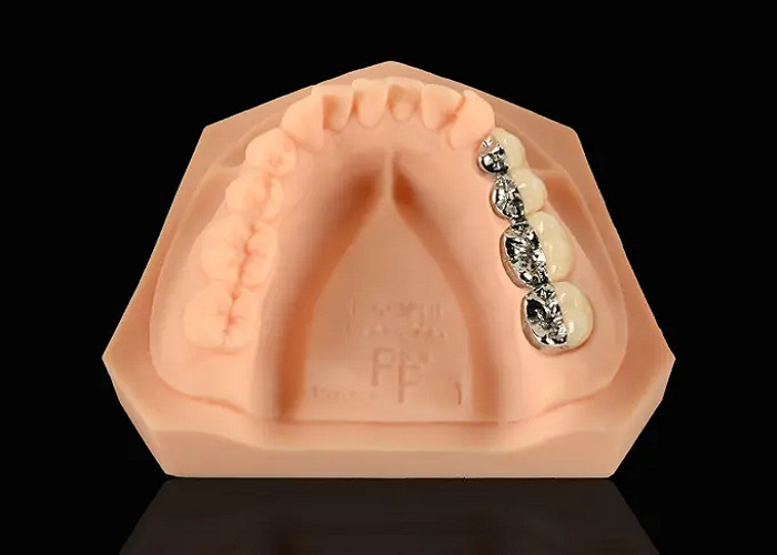 What Are the Outstanding Features of PFM Dental Bridges? - Golden Smile ...