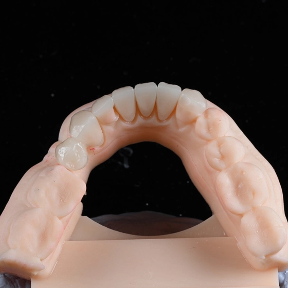E Max Crown Price Cerec Emax Golden Smile Dental Lab